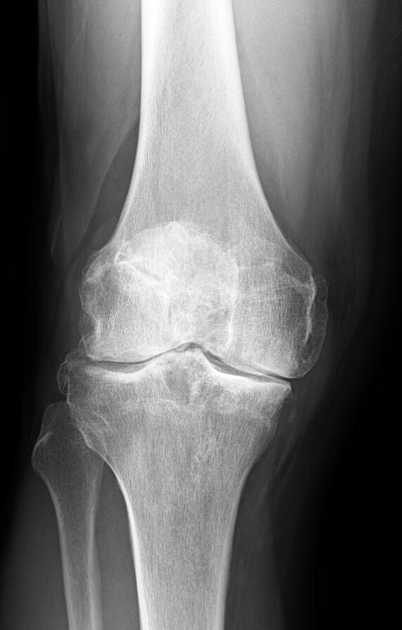 OA knee - Orthosport Victoria