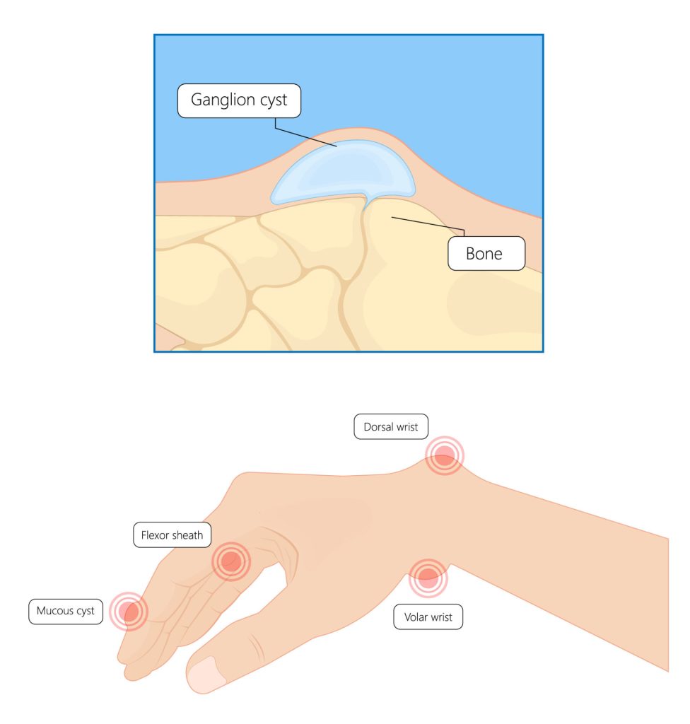 Ganglion Cyst Removal Melbourne | Hand And Wrist Cyst Care
